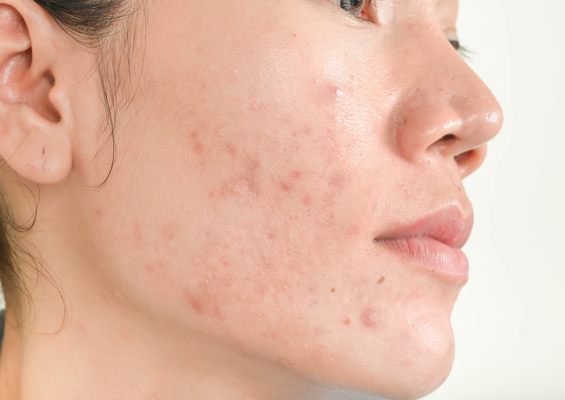 Acne Scars: Understanding and Treating Varied Types – Revival Skin UK